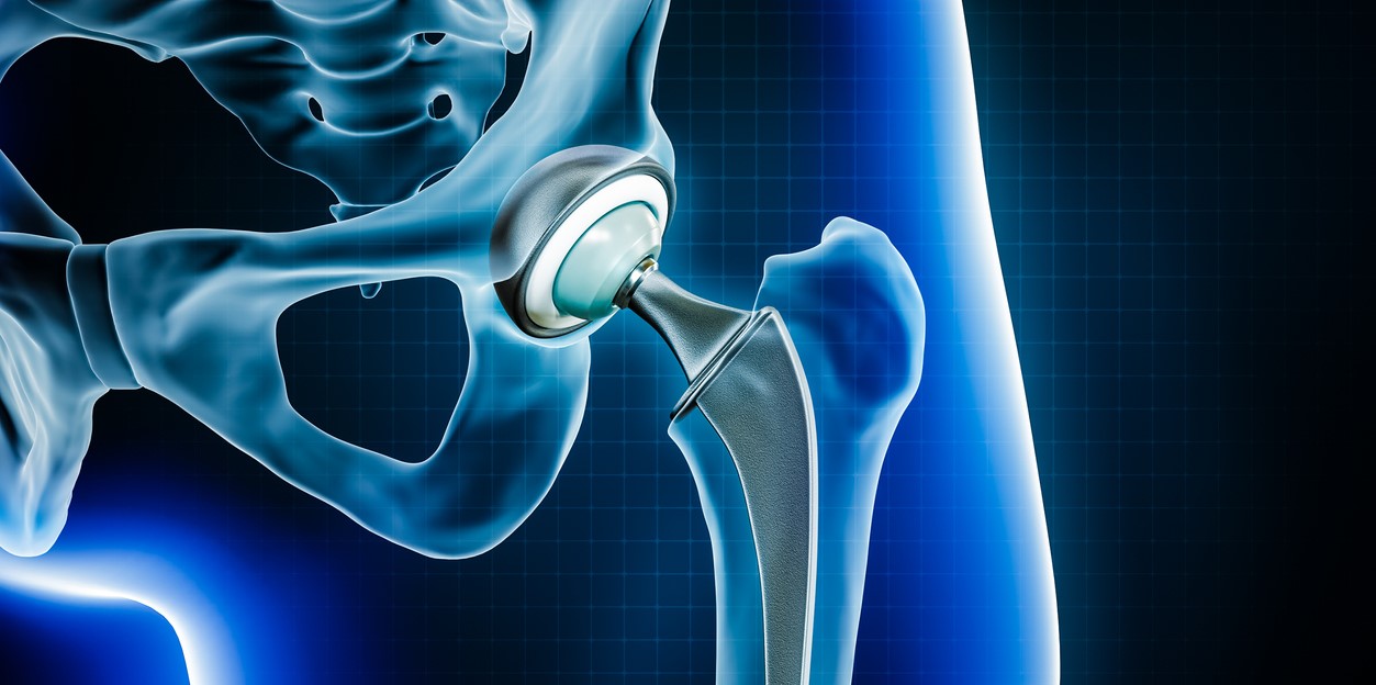 Common Myths About Hip Replacement Surgery